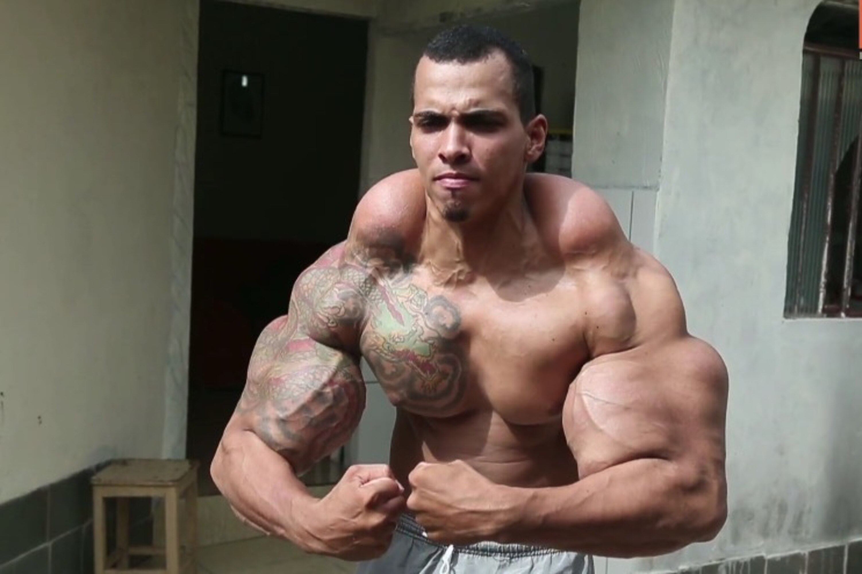 Bodybuilder Nearly Lost Arms After Injecting Muscles with Synthol